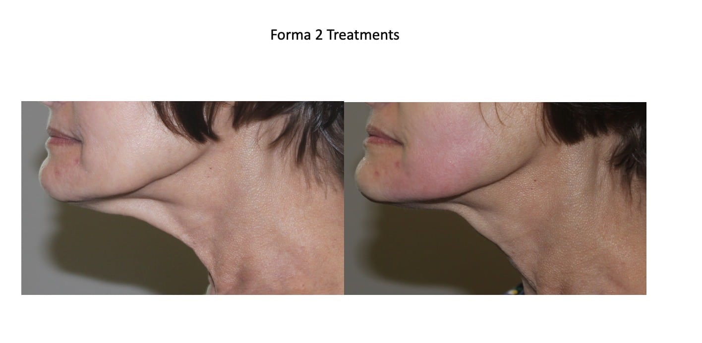 Forma Skin Tightening | Fort Mill, SC