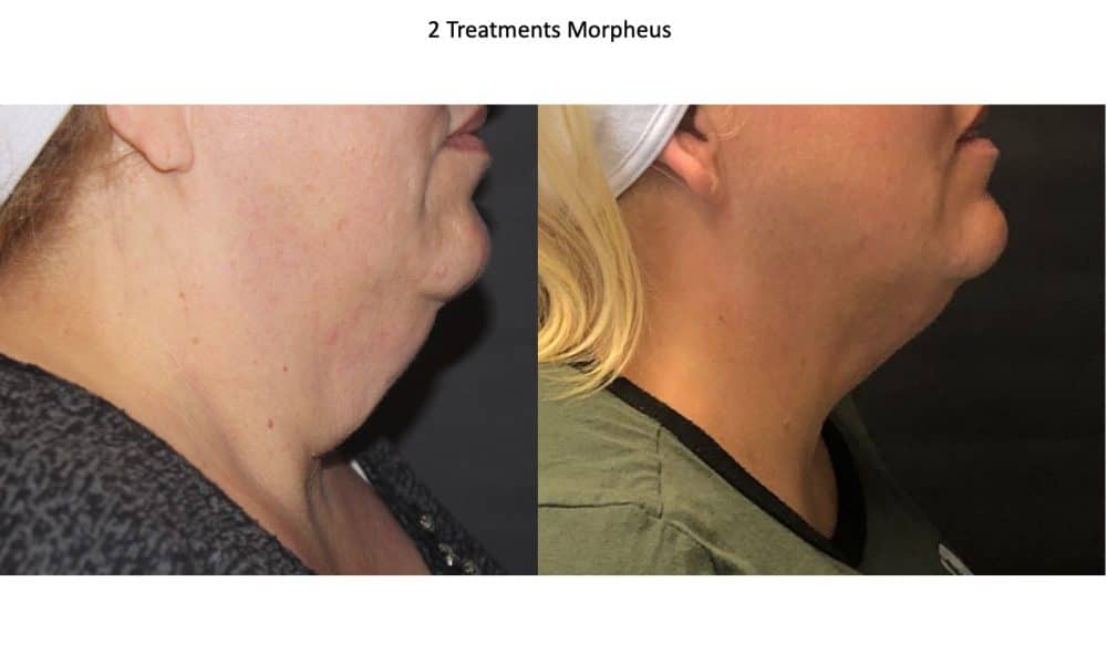 Morpheus RF Microneedling | Fort Mill, SC
